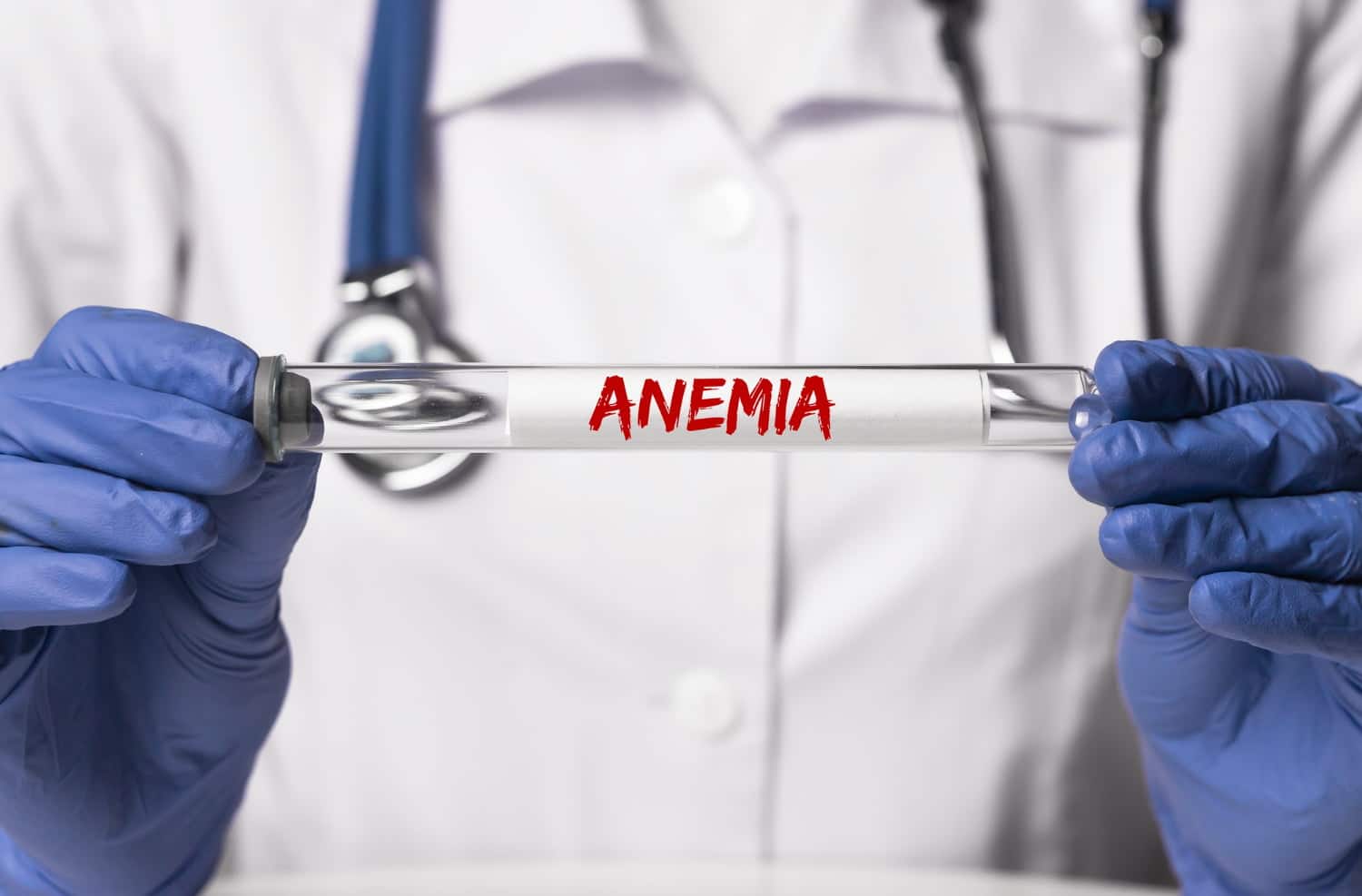 La anemia por deficiencia de hierro: Causas, síntomas y tratamiento