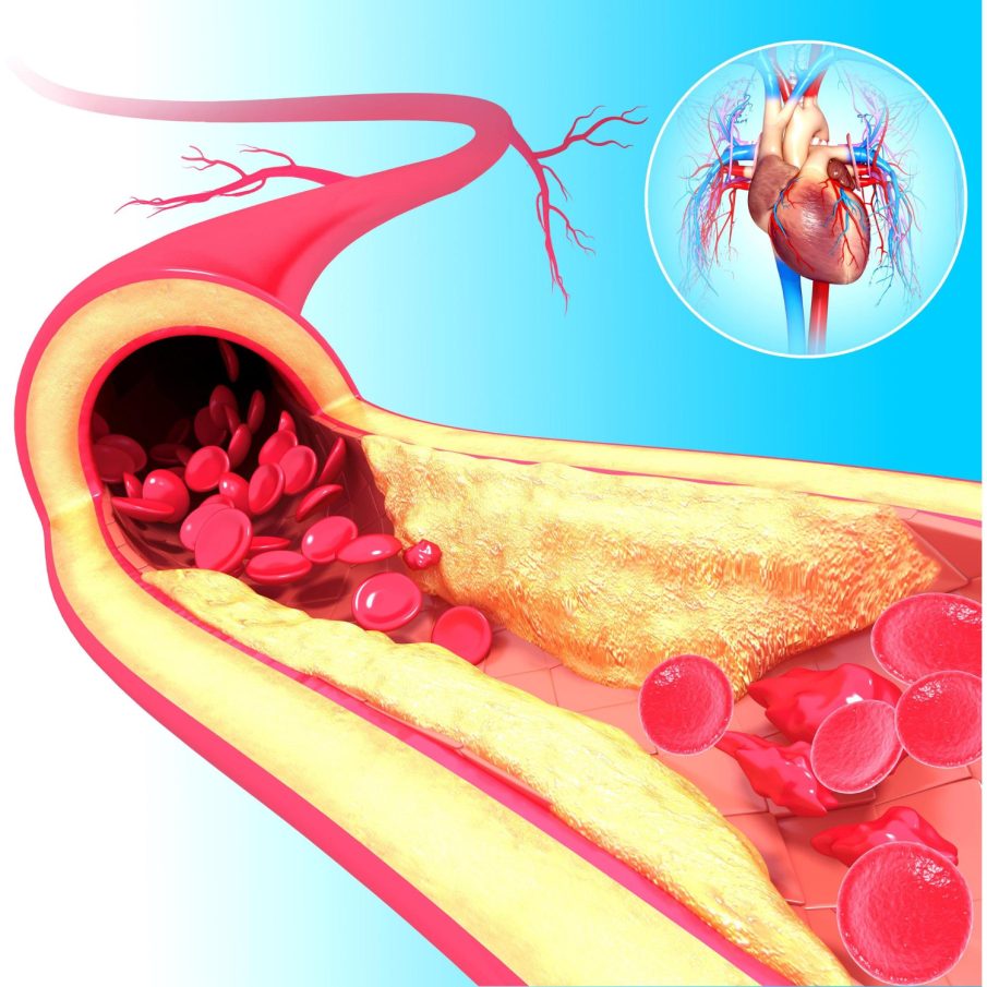 Cómo evitar la obstrucción de las arterias y prevenir la aterosclerosis